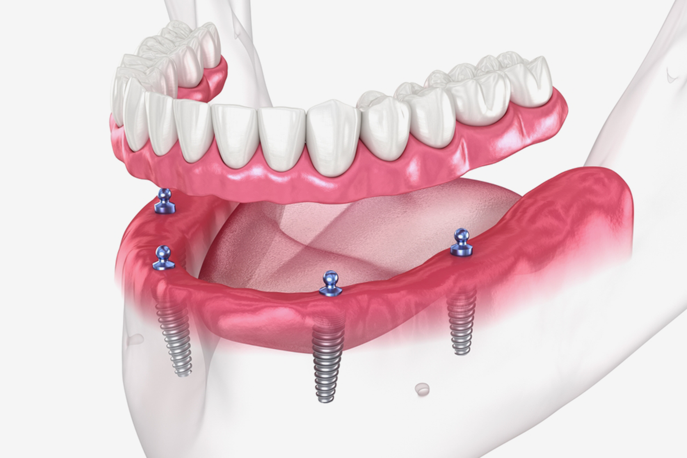 Hybrid Dentures in Vacaville